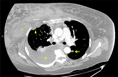 Fungating Mass as First Presentation of Advanced Breast Cancer ...