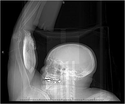 Contrast Extravasation into the Right Upper Extremity | SpringerLink