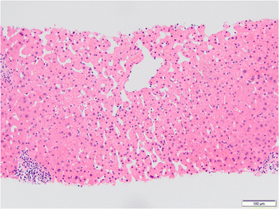 Expanding the differential diagnosis for transaminitis in patients with ...