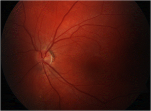 Coloboma of the Optic Disc and Retina | SpringerLink