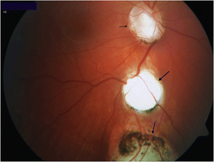 Coloboma of the Optic Disc and Retina | SpringerLink