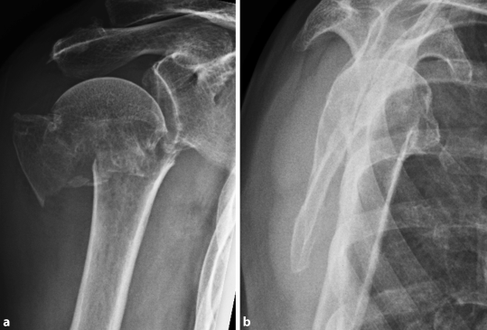 Cement augmentation of humeral head screws reduces early implant ...