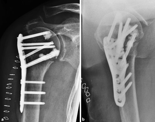 Cement augmentation of humeral head screws reduces early implant ...