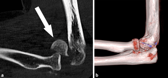 Fractures of the capitellum humeri and their associated injuries ...