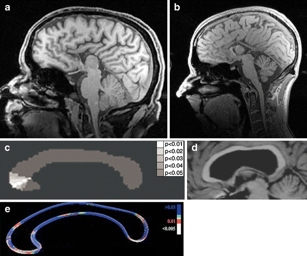 Developmental malformation of the corpus callosum: a review of typical ...
