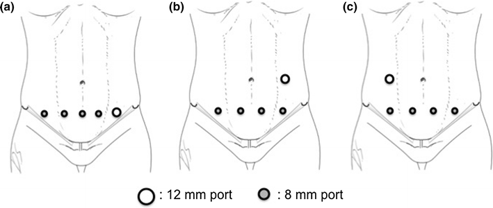 Universal suprapubic approach for complete mesocolic excision and central vascular ligation ...