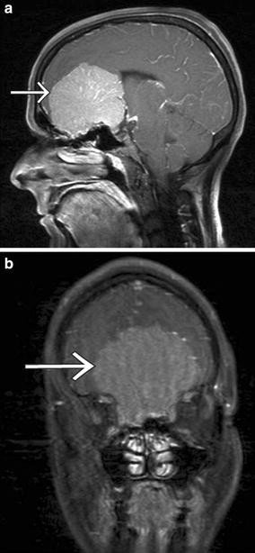 An unusual presentation of subfrontal meningioma: a case report and ...