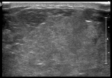 Emergency management of puerperal breast abscess | SpringerLink