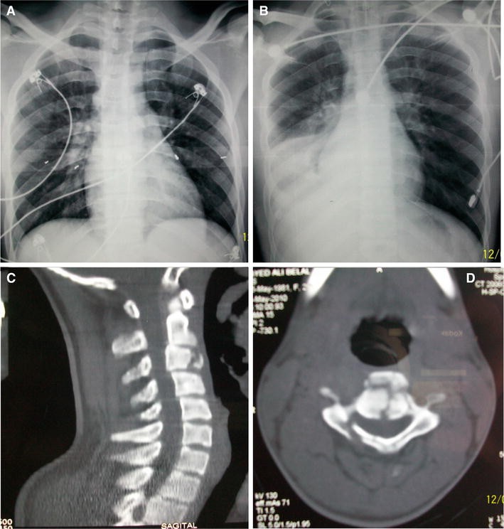 Diaphragmatic paralysis following blunt neck trauma | SpringerLink