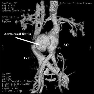 Aortocaval fistula | SpringerLink