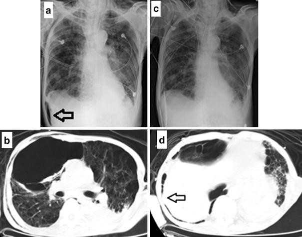 The deep sulcus sign indicates free air in the abdomen | SpringerLink