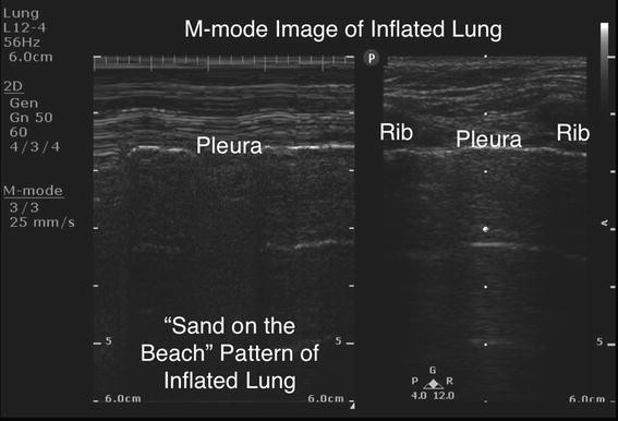 Ultrasound guided chest tube placement for basilar pneumothorax ...