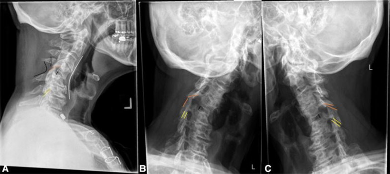 Perched facets diagnosed in a neurologically intact patient 5 weeks ...