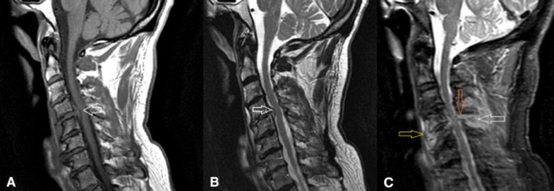 Perched facets diagnosed in a neurologically intact patient 5 weeks ...
