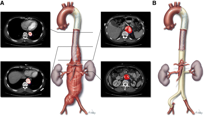 Open aortic surgery after thoracic endovascular aortic repair ...