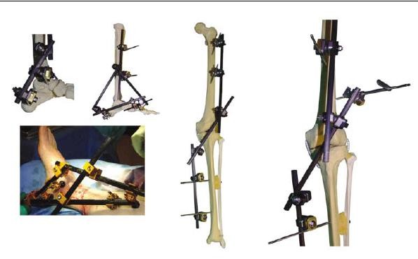 Stability with unilateral external fixation in the tibia | SpringerLink