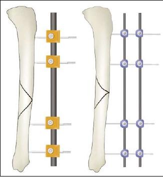Stability with unilateral external fixation in the tibia | SpringerLink