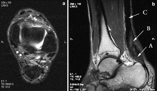 Neglected Achilles tendon rupture with central insertional plantaris ...