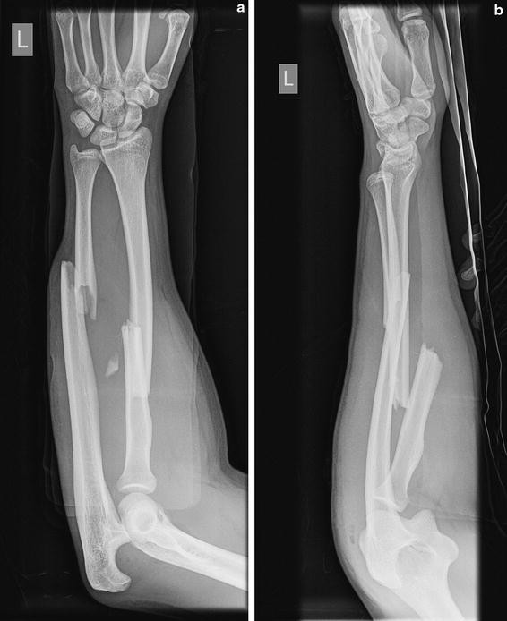 Complex elbow dislocation associated with radial and ulnar diaphyseal ...