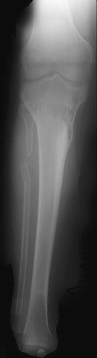 The treatment of high tibial osteotomy non-union with the Ilizarov ...