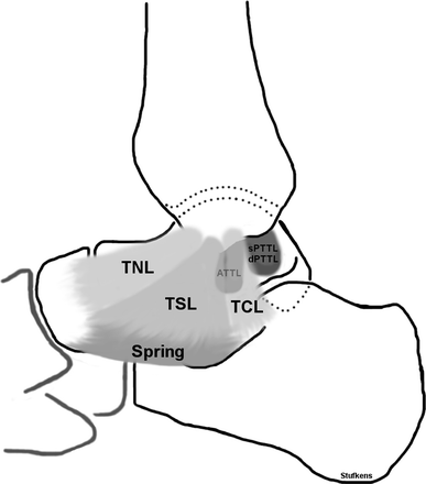 The diagnosis and treatment of deltoid ligament lesions in supination ...