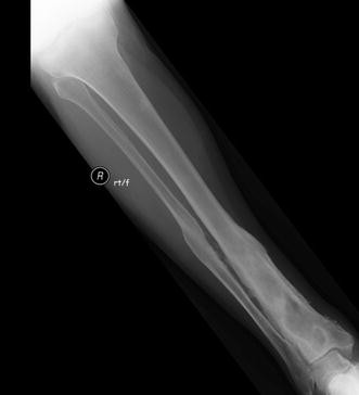 Adjuvant treatment of chronic osteomyelitis of the tibia following ...