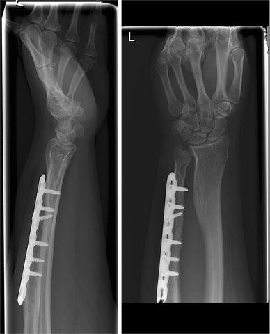 Reconstruction of the DRUJ in a young adult after resection of a large ...