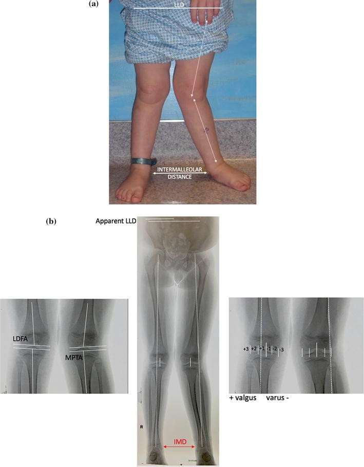 Cozen’s deformity: resolved by guided growth | SpringerLink