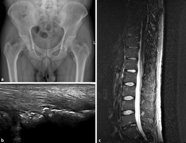 Spondyloarthritis | SpringerLink