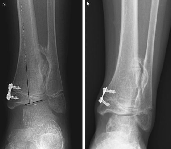 Correction of ankle valgus by hemiepiphysiodesis using the tension band ...