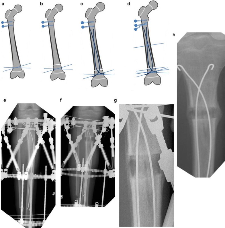 Current approaches to flexible intramedullary nailing for bone ...