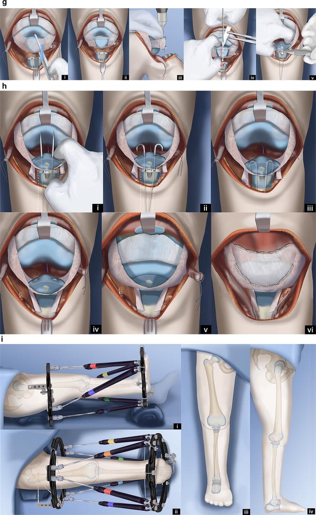 Tibial hemimelia: new classification and reconstructive options ...