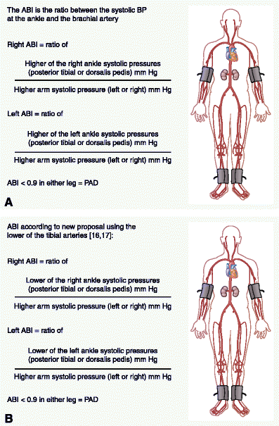 Peripheral Artery Disease (PAD) Screening in the Asymptomatic ...