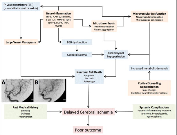 Delayed Cerebral Ischemia after Subarachnoid Hemorrhage: Beyond ...