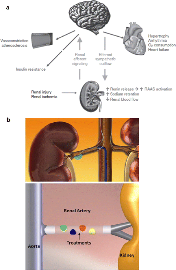 How Does Renal Denervation Lower Blood Pressure and When Should This ...