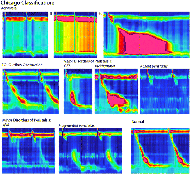 Chicago Classification of Esophageal Motility Disorders: Lessons ...