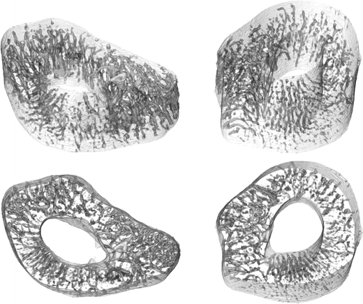 Cortical Bone Porosity: What Is It, Why Is It Important, and How Can We ...