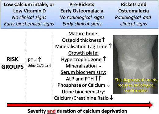 Nutritional Rickets and Osteomalacia in the Twenty-first Century ...