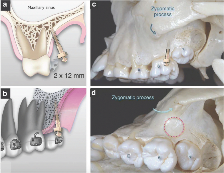 Extra-Alveolar Bone Screws for Conservative Correction of Severe ...