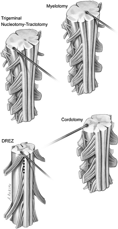 Surgical/Radiological Interventions for Cancer Pain | SpringerLink