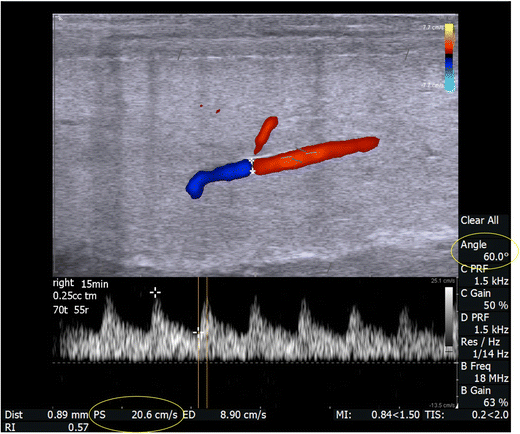 Penile Doppler Ultrasound Predicting Cardiovascular Disease in Men with ...