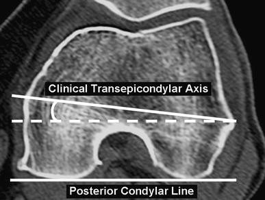 Rotational Position of Femoral and Tibial Components in TKA Using the ...