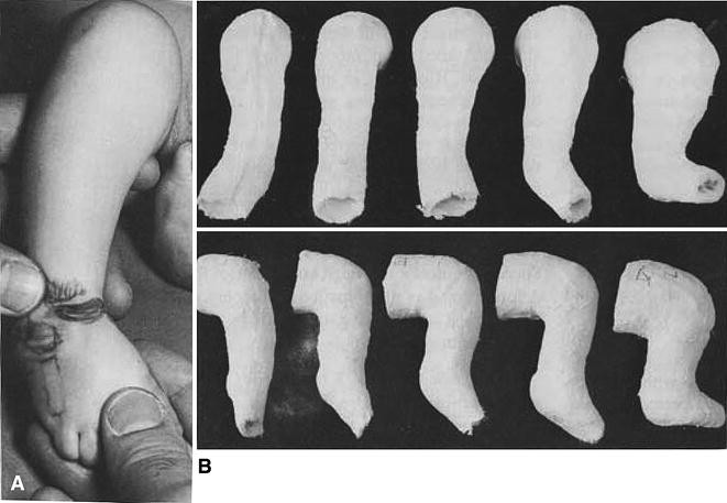 The Classic: Observations on Pathogenesis and Treatment of Congenital ...