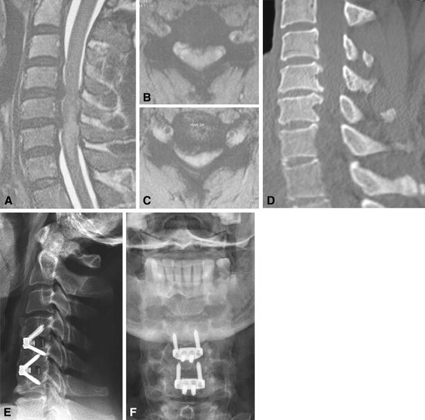 A New Zero-profile Implant for Stand-alone Anterior Cervical Interbody ...
