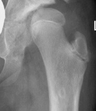 Reliability of Bucholz and Ogden Classification for Osteonecrosis ...