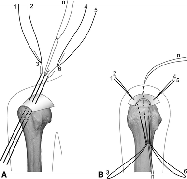 Advantages of Arthroscopic Transosseous Suture Repair of the Rotator ...