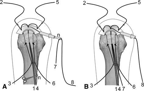 Advantages of Arthroscopic Transosseous Suture Repair of the Rotator ...