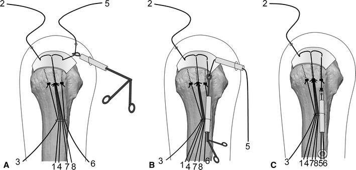 Advantages of Arthroscopic Transosseous Suture Repair of the Rotator ...