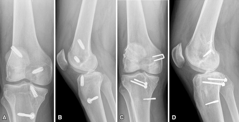 A Novel Posteromedial Approach for Tibial Inlay PCL Reconstruction in KDIIIM Injuries: Avoiding ...