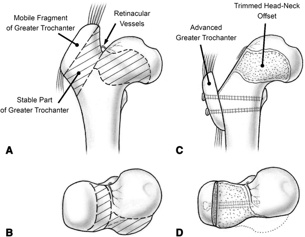 Relative Femoral Neck Lengthening Improves Pain and Hip Function in ...
